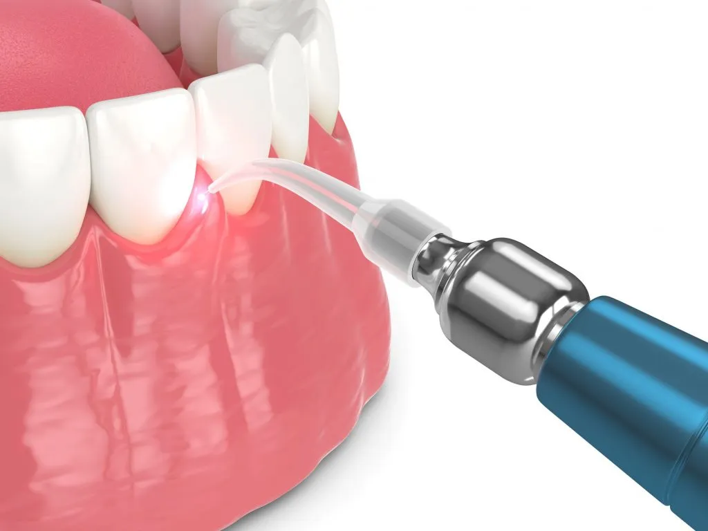 LANAP Laser Treatment | Laser Periodontal Surgery | LANAP Procedure